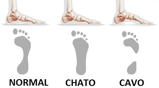 Descubra seu tipo de pisada, melhore seu rendimento e evite lesões ...